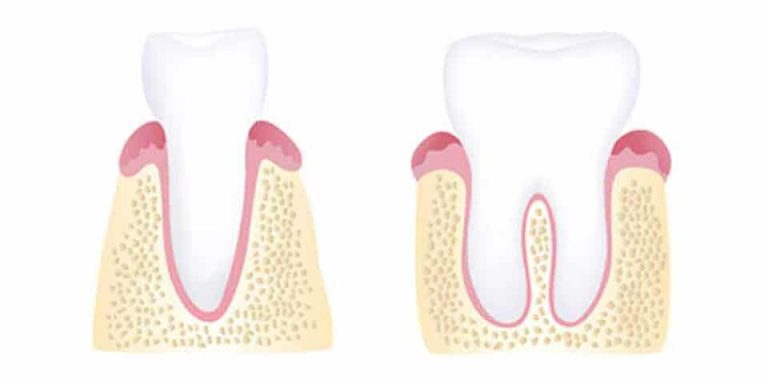 Stages of Periodontal Disease | Meadows Dental Associates